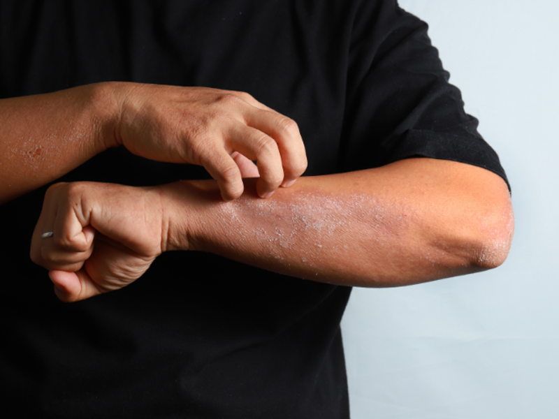 Challenges of diagnosis and management of eczema in patients with skin ...